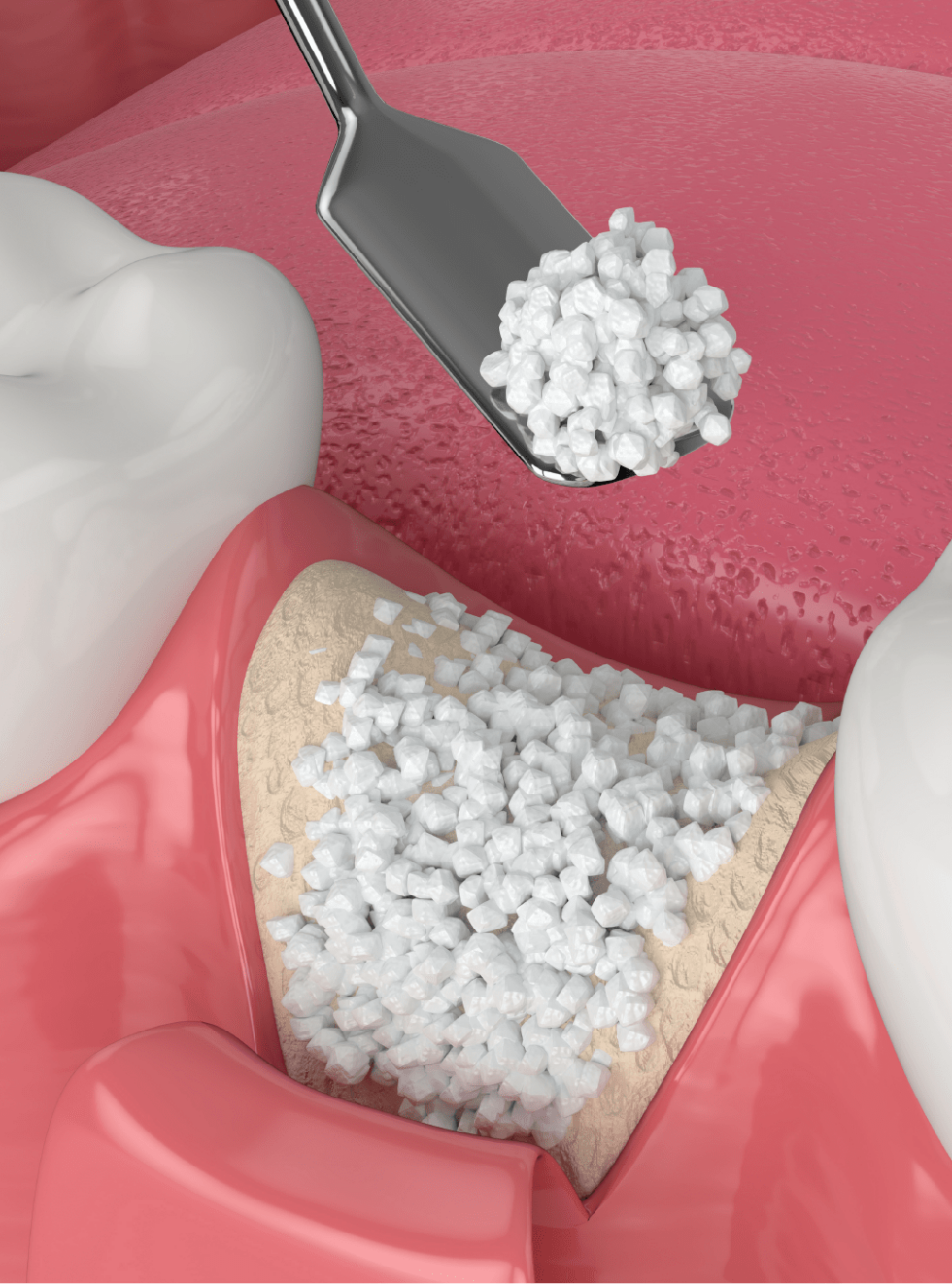 Bone Preservation & Regeneration Memphis TN | Socket Preservation