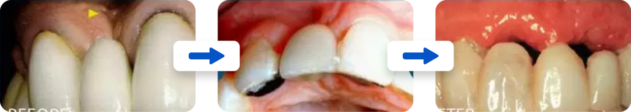 Ridge Augmentation Memphis TN | Soft Tissue Grafting